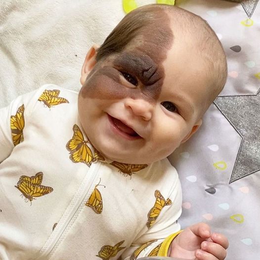 This baby girl was trolled for her looks — now at 2 years old, she is ...